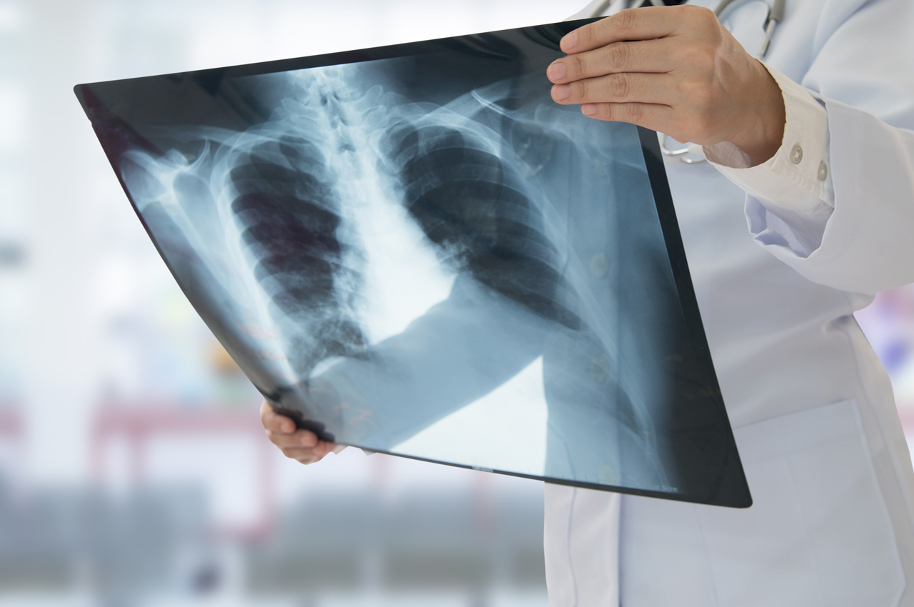 TUBERCULOSIS MULTIRRESISTENTE